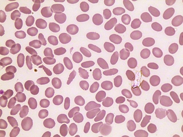 Definición de ovalocitos