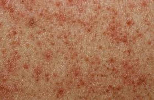 Hiperqueratosis folicular: causas y tratamiento - con fotos