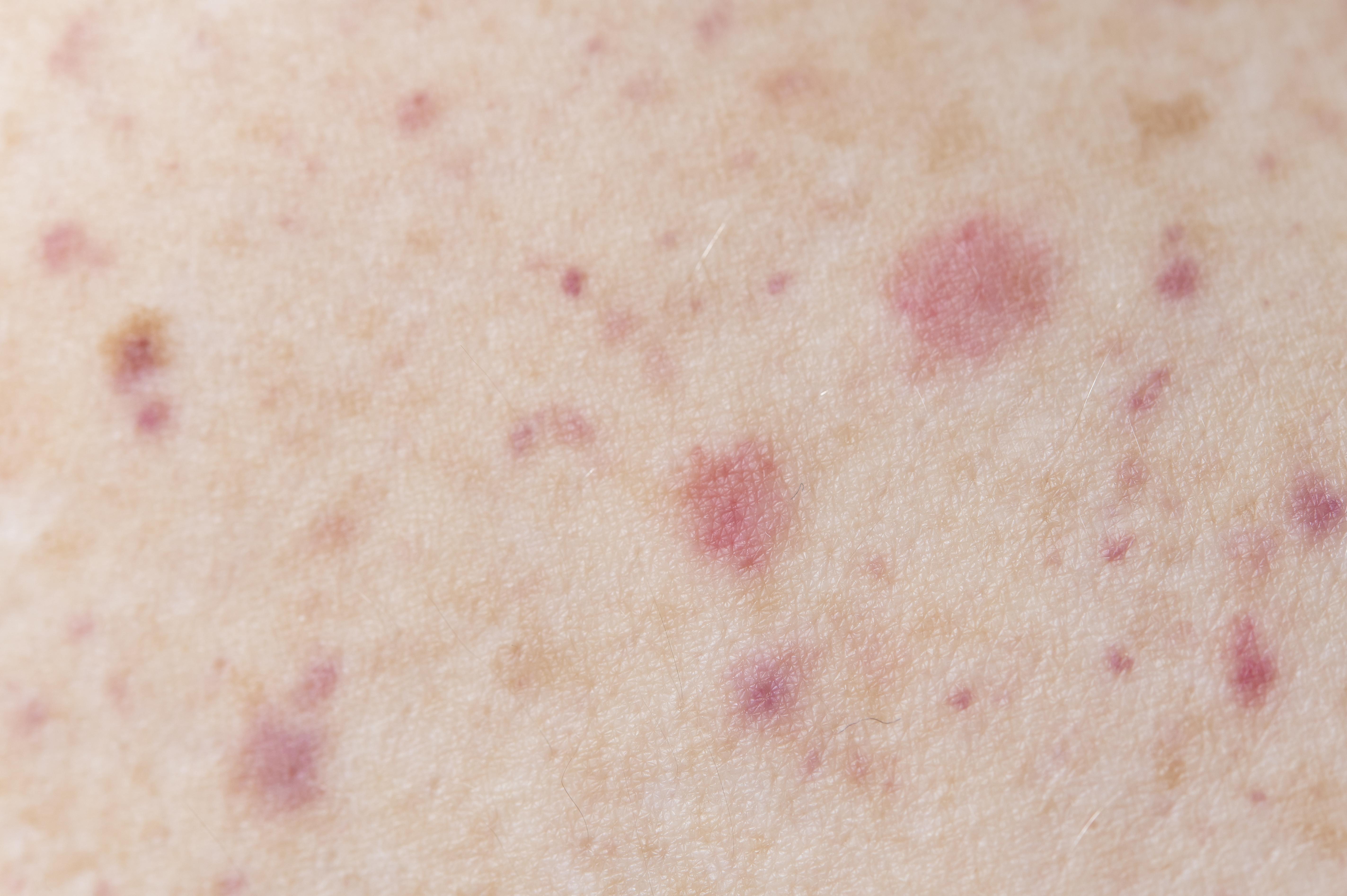 Sarpullido en la barriga con picor: Causas y tratamiento Sarpullido en la barriga con picor: Causas y tratamiento