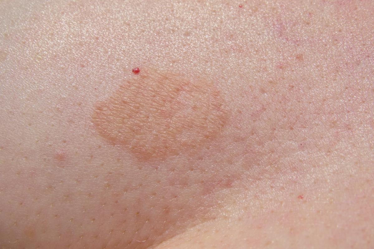 Tipos de hongos en la piel y cómo eliminarlos