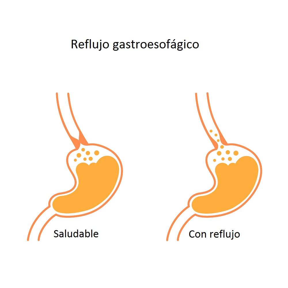 REFLUJO GASTROESOFÁGICO: Causas, Síntomas y Tratamiento