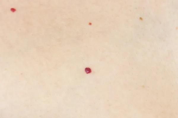 Por qué tengo un lunar rojo en el pecho y qué hacer
