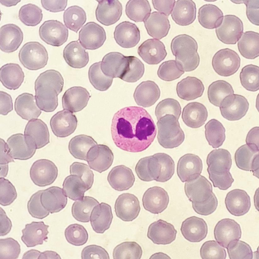 Eosinopenia: qué es, causas, síntomas y tratamiento