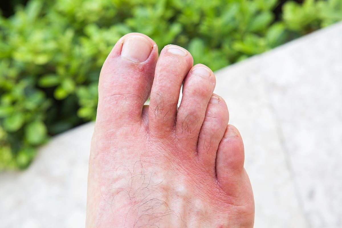 Granitos en los pies que pican mucho: causas y tratamiento