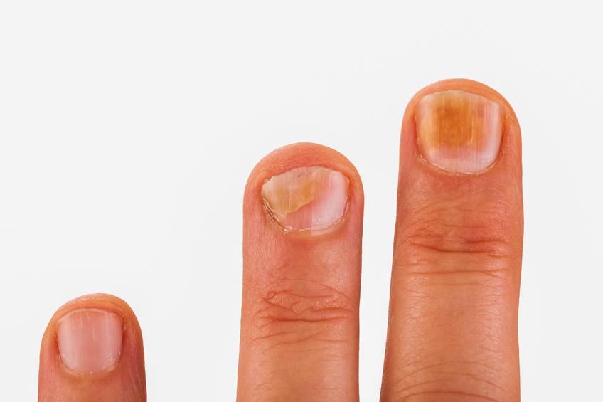 RAYAS en las UÑAS: Por Qué Salen y Qué Significan