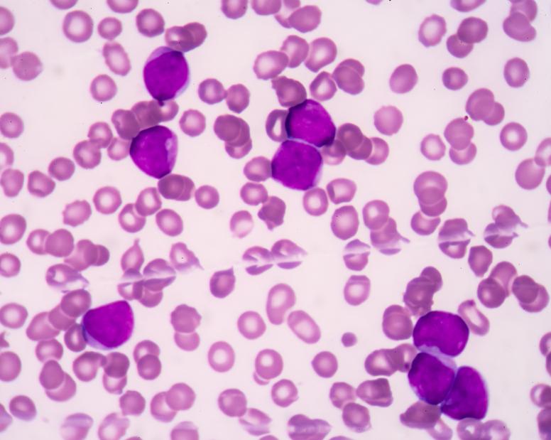 Linfoma no Hodgkin: síntomas, tipos y tratamiento