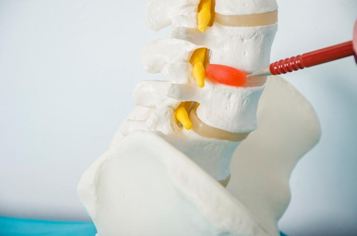 Lumbociática aguda: causas y tratamiento