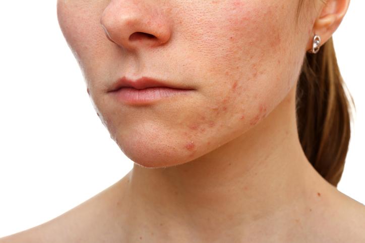 Por Qué Me Salen Ronchas En El Cuerpo Y Luego Desaparecen